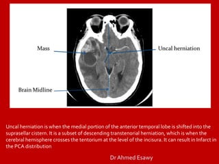Full story brain herniation imaging Dr Ahmed Esawy | PDF