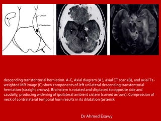 Full story brain herniation imaging Dr Ahmed Esawy | PDF