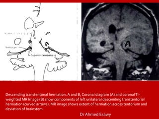 Full story brain herniation imaging Dr Ahmed Esawy | PDF