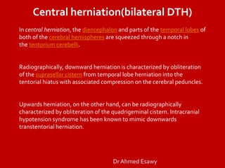 Full story brain herniation imaging Dr Ahmed Esawy | PDF