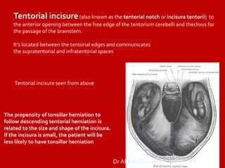 Full story brain herniation imaging Dr Ahmed Esawy | PDF