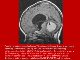Full story brain herniation imaging Dr Ahmed Esawy | PDF