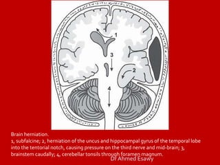 Uncal Herniation Cranial Nerve 3
