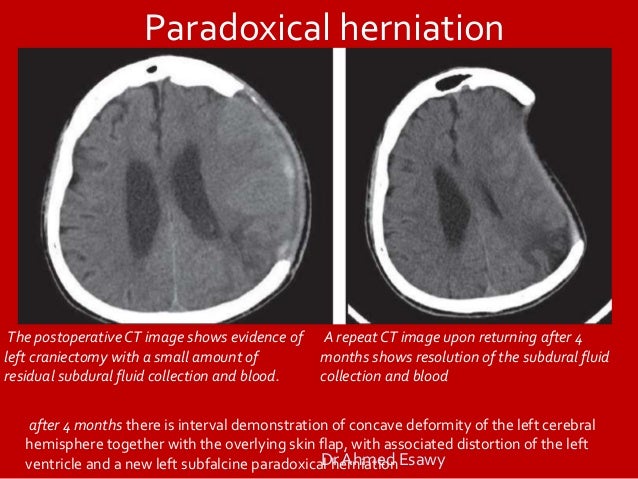 Full story brain herniation imaging Dr Ahmed Esawy