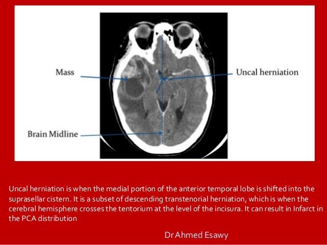 Full story brain herniation imaging Dr Ahmed Esawy