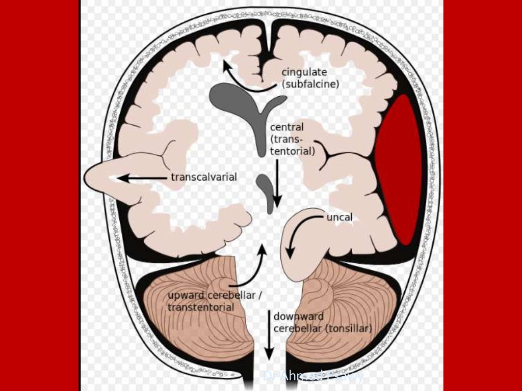 Full story brain herniation imaging Dr Ahmed Esawy