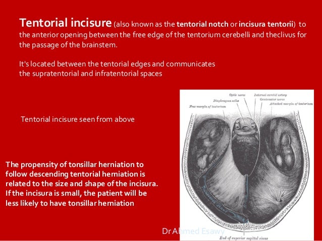 Full story brain herniation imaging Dr Ahmed Esawy