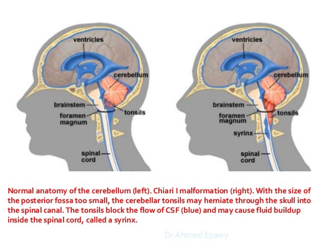 Full story brain herniation imaging Dr Ahmed Esawy