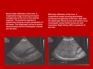 Fatty Liver Ultrasound Vs Normal Liver