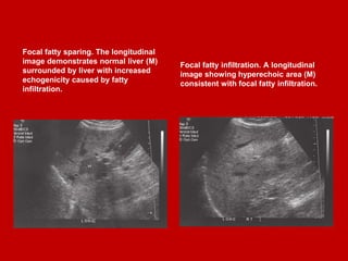 Normal Vs Fatty Liver Ultrasound
