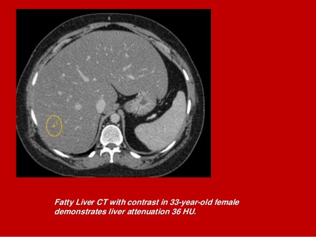 Full story fatty liver imaging Dr Ahmed Esawy