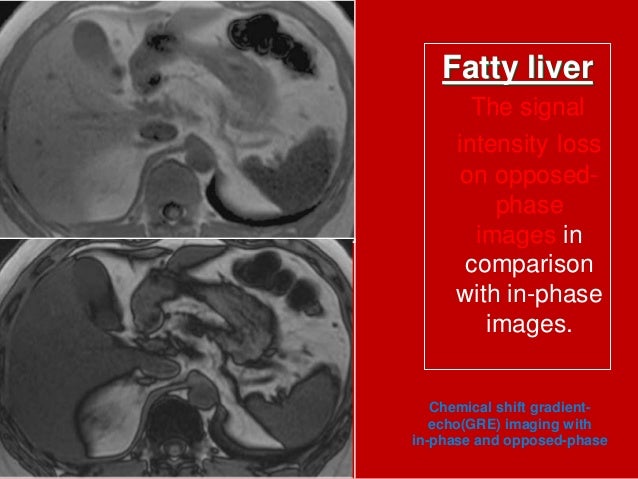 Full story fatty liver imaging Dr Ahmed Esawy
