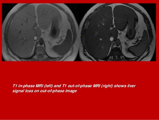 Full story fatty liver imaging Dr Ahmed Esawy
