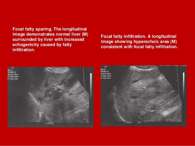 Full story fatty liver imaging Dr Ahmed Esawy