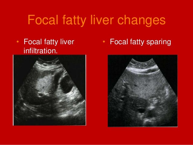 Full story fatty liver imaging Dr Ahmed Esawy