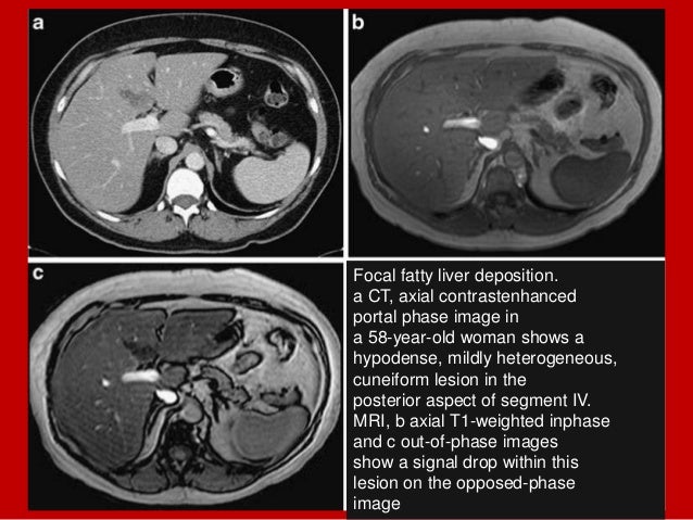 Full story fatty liver imaging Dr Ahmed Esawy