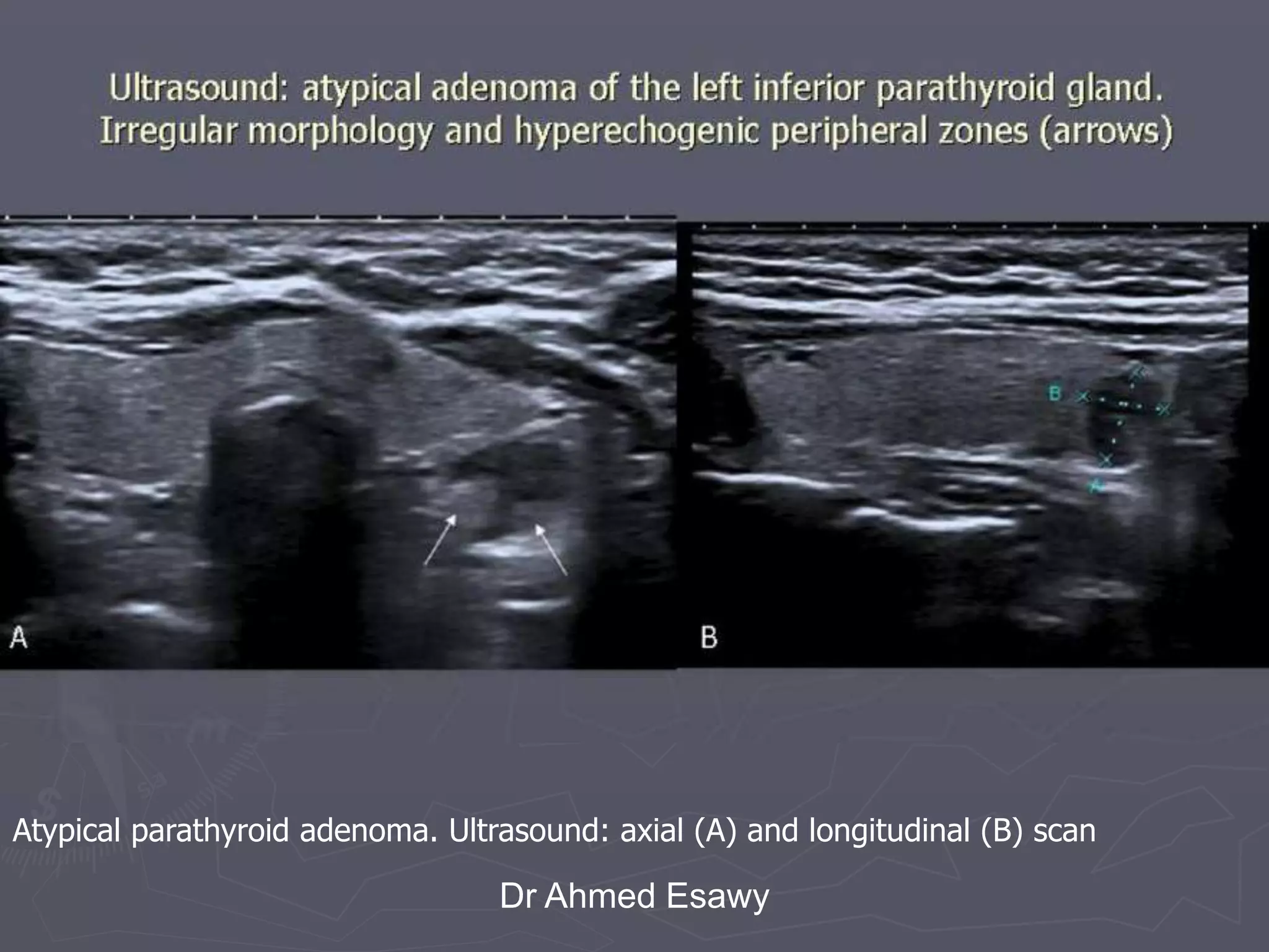 Full story parathyroid imaging Dr Ahmed Esawy | PDF