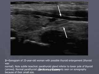 Parathyroid Ultrasound