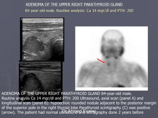 Parathyroid Gland Ultrasound