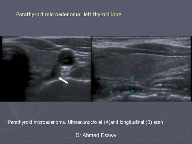 Full story parathyroid imaging Dr Ahmed Esawy