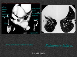 Full story pulomnary embolism imaging Dr Ahmed Esawy | PDF