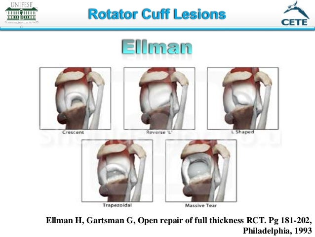Full thickness rotator cuff: Diagnosis and Management