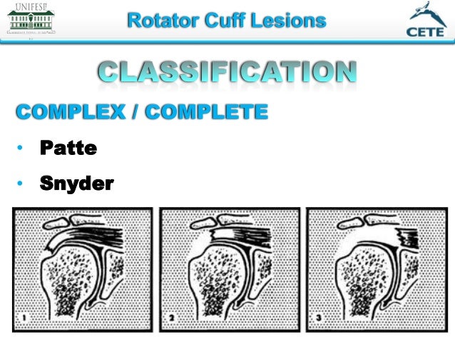 Full thickness rotator cuff: Diagnosis and Management