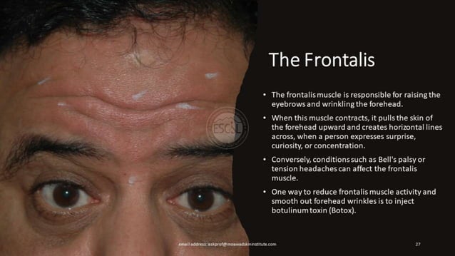 Functional Anatomy of Facial Muscles. An Injector Eye. Part One.pptx