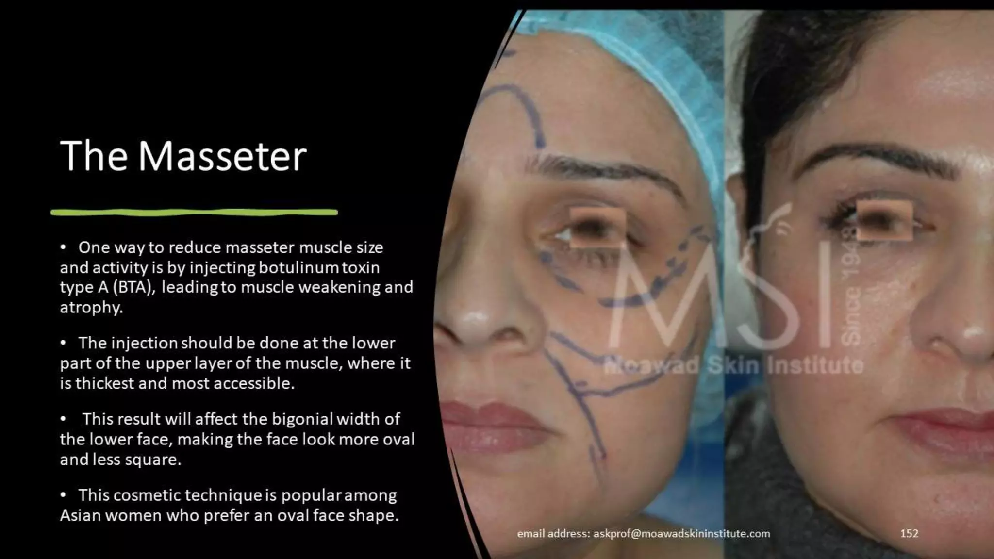 Functional Anatomy of Facial Muscles. An Injector Eye. Part Two.pptx