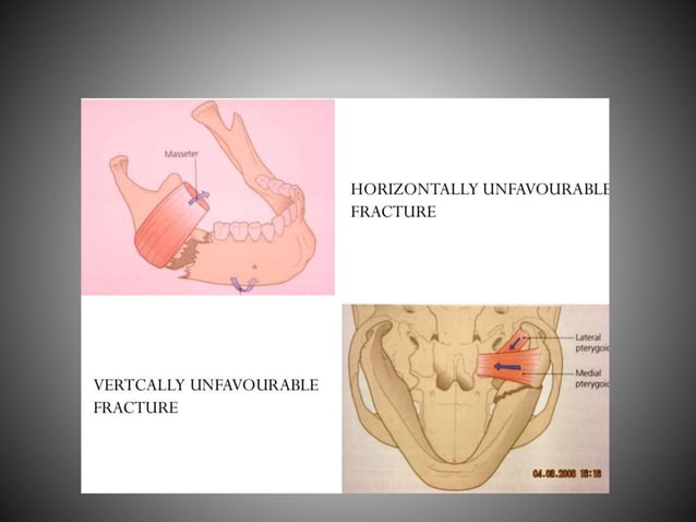 Functional anatomy of mandible | PPT