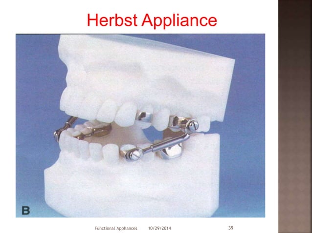 Functional appliances | PPTX | Dental Health | Diseases and Conditions