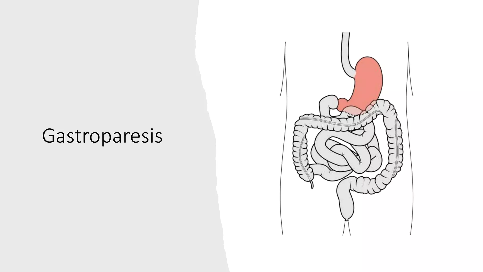 Functional bowel disorders | PPTX | Digestive Disorders | Diseases and ...