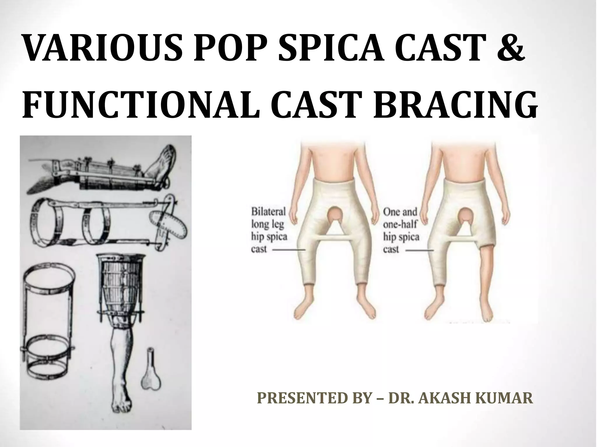 Functional cast bracing and various pop spica cast | PPTX