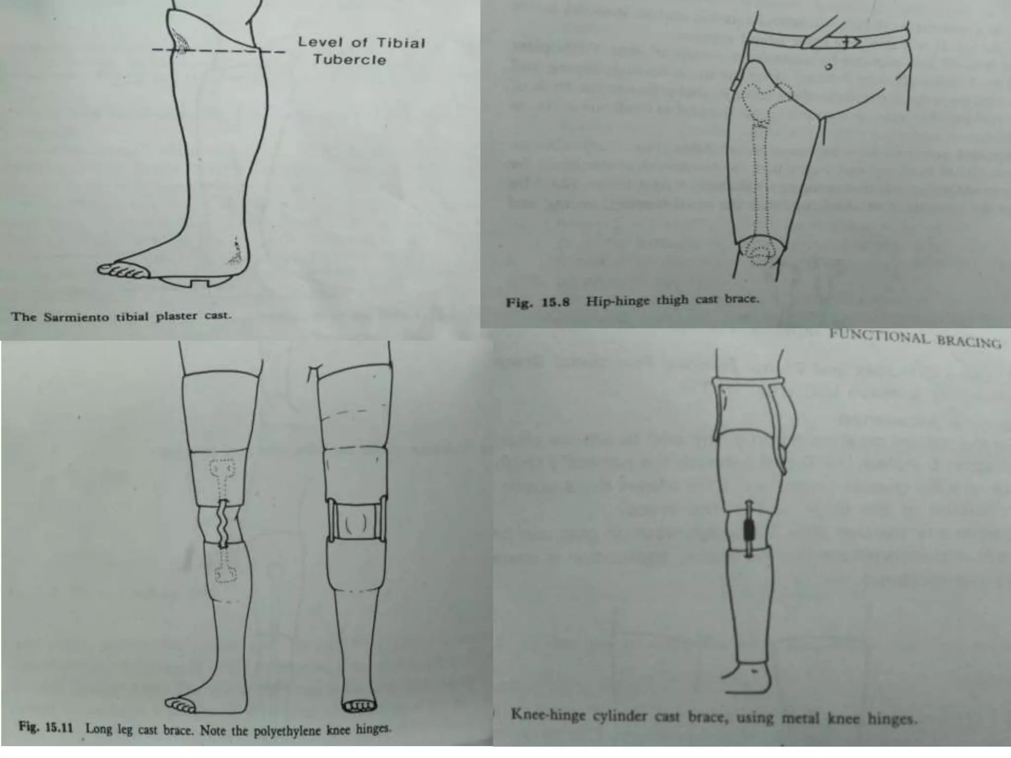 Functional cast bracing and various pop spica cast | PPTX
