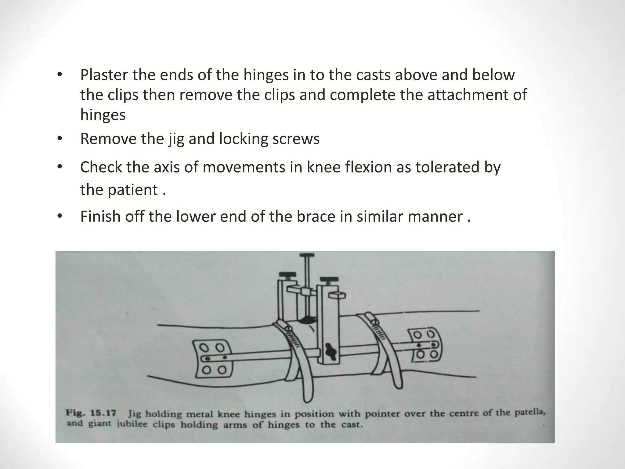 Functional cast bracing and various pop spica cast | PPTX