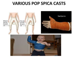 Functional cast bracing and various pop spica cast | PPTX