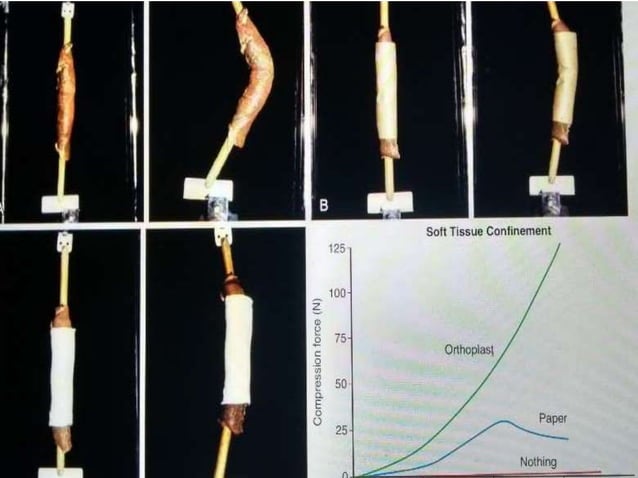 Functional cast bracing and various pop spica cast | PPTX | Death ...