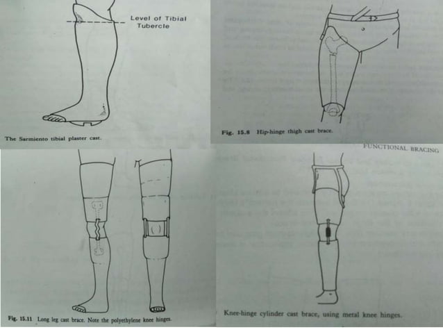 Functional cast bracing and various pop spica cast | PPTX | Death ...