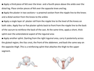 Functional cast bracing and various pop spica cast | PPTX