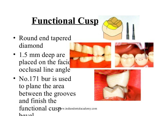 Functional cusp /certified fixed orthodontic courses by Indian dental…