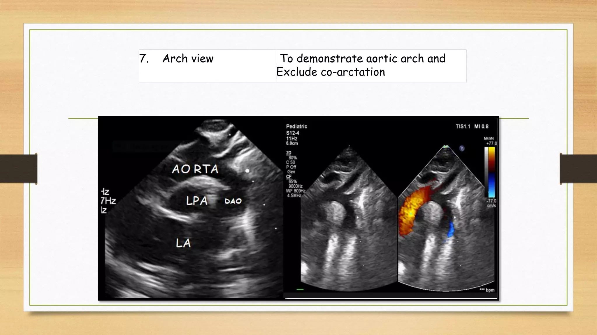 Functional echocardiography ppt | PDF