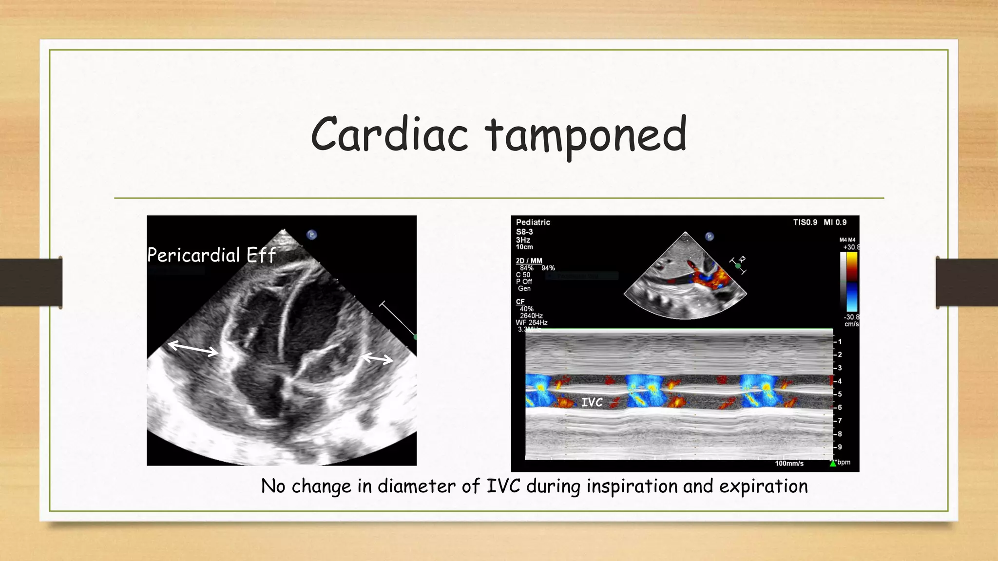 Functional echocardiography ppt | PDF