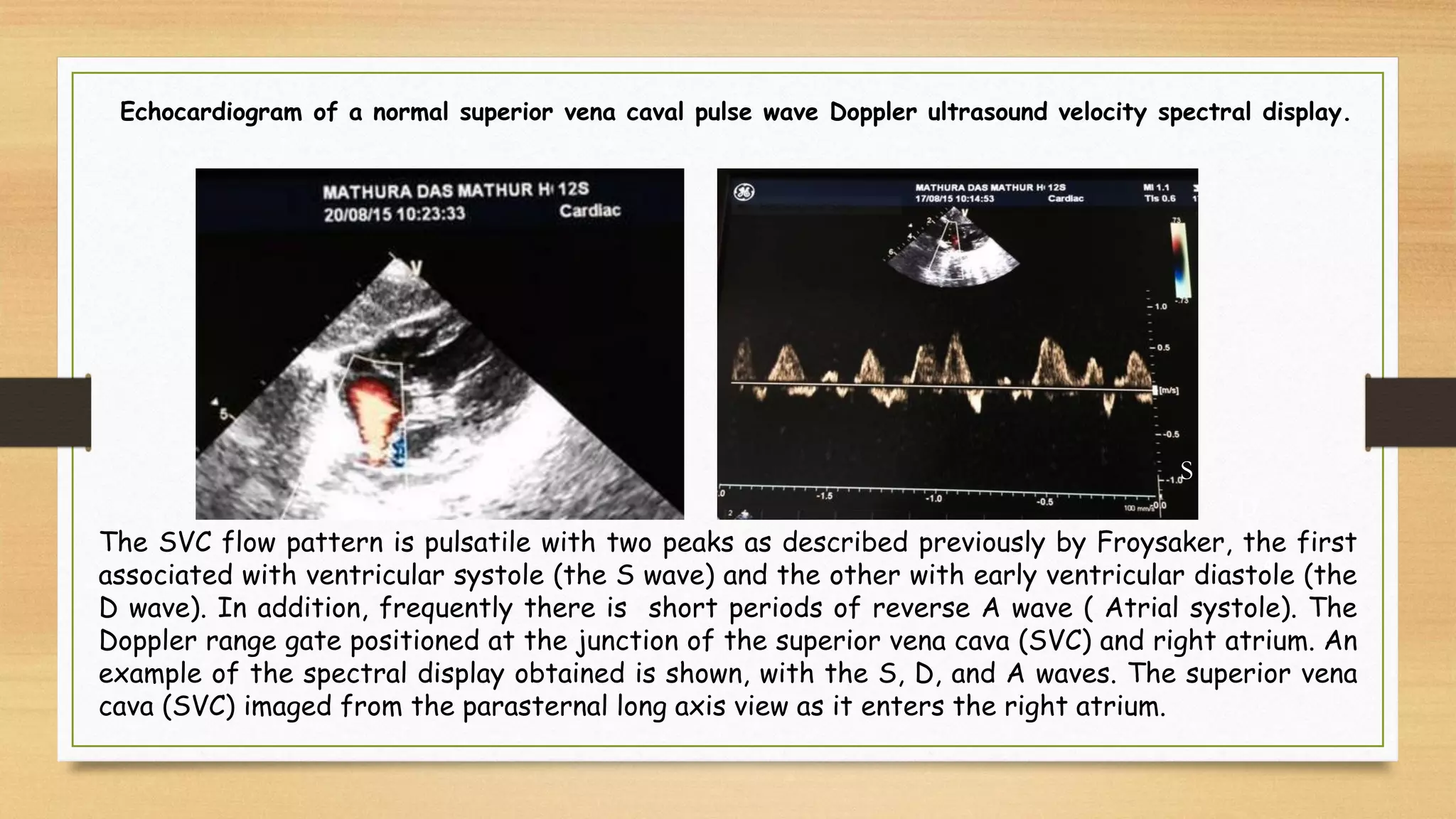 Functional echocardiography ppt | PDF