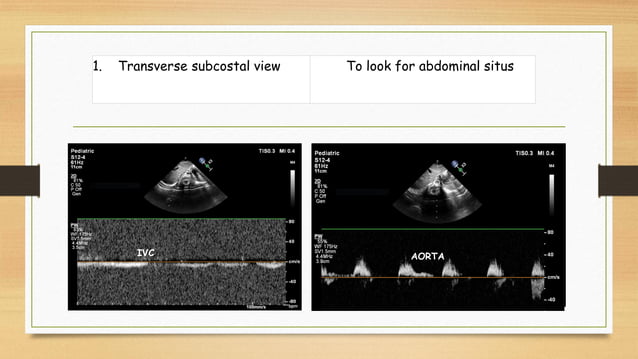 Functional echocardiography ppt | PDF | Heart and Cardiovascular Diseases | Diseases and Conditions