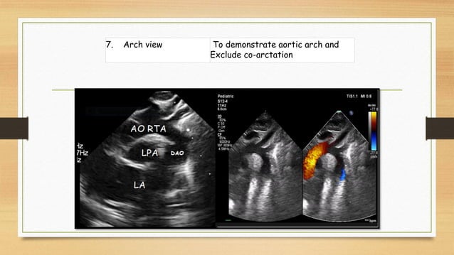 Functional echocardiography ppt | PDF | Heart and Cardiovascular ...
