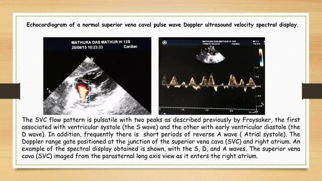 Functional echocardiography ppt | PDF | Heart and Cardiovascular ...