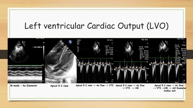 Functional echocardiography ppt | PDF | Heart and Cardiovascular Diseases | Diseases and Conditions