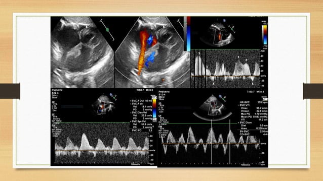 Functional echocardiography ppt | PDF | Heart and Cardiovascular Diseases | Diseases and Conditions