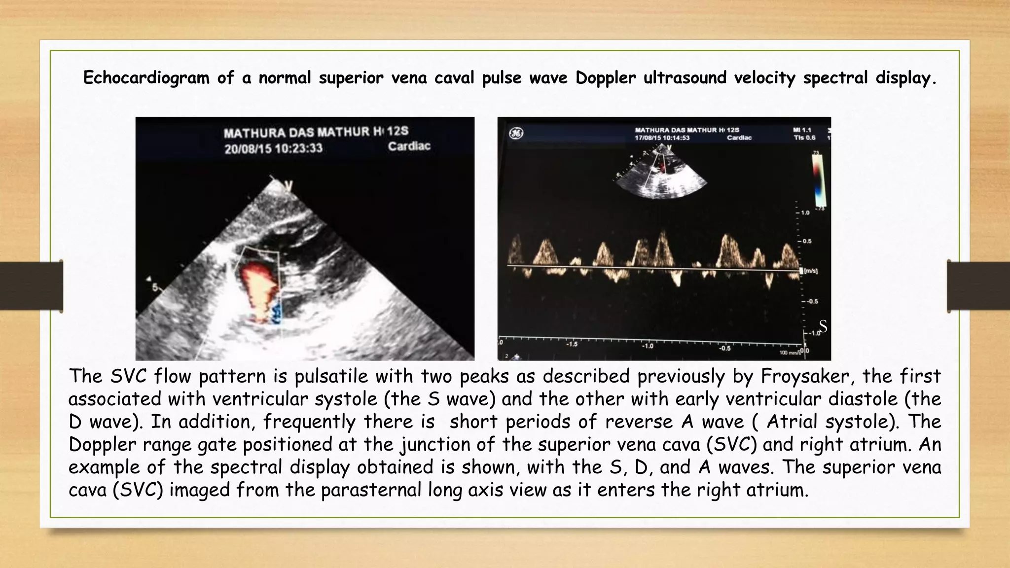 Functional echocardiography ppt nov 2020 | PDF