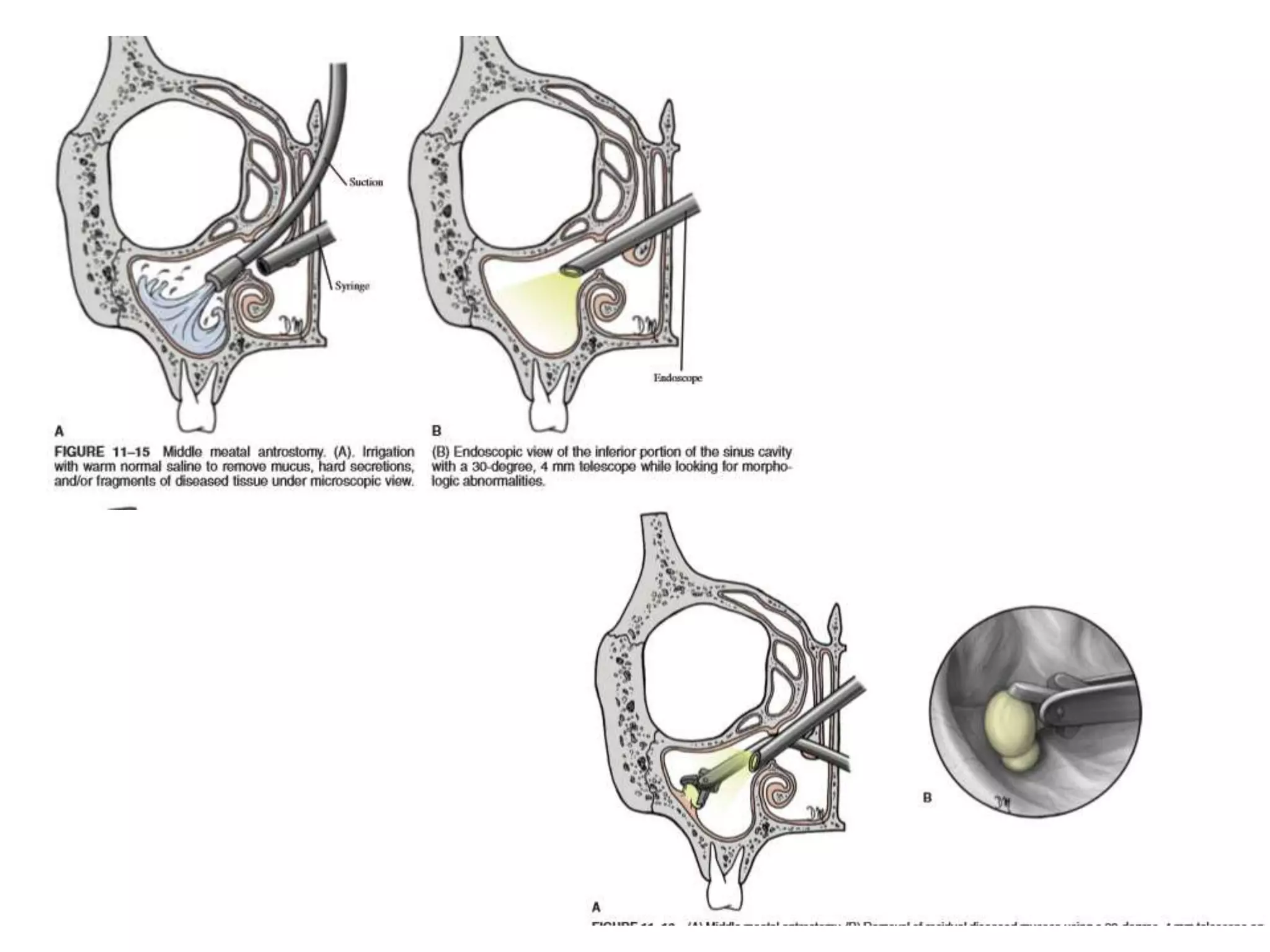 Functional Endoscopic Sinus Surgery Ppt